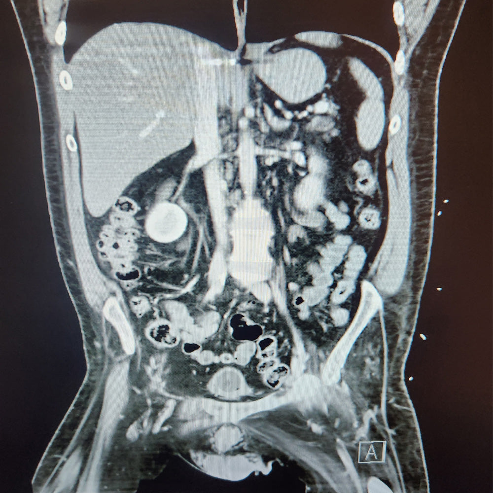 Anatomía Del Abdomen Y La Pelvis Por Tomografía Computarizada